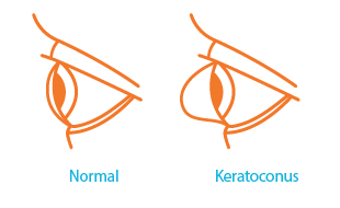 World Keratoconus Day | The Eye Center of North Florida
